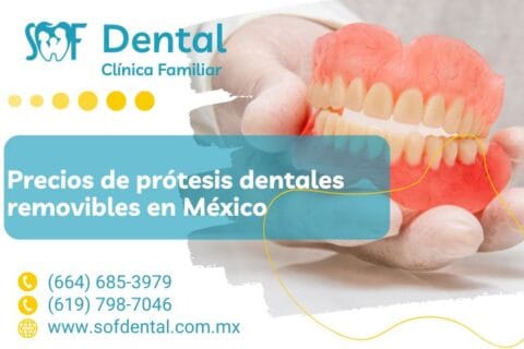 Precios de prótesis dentales removibles en México - SOFDental ...